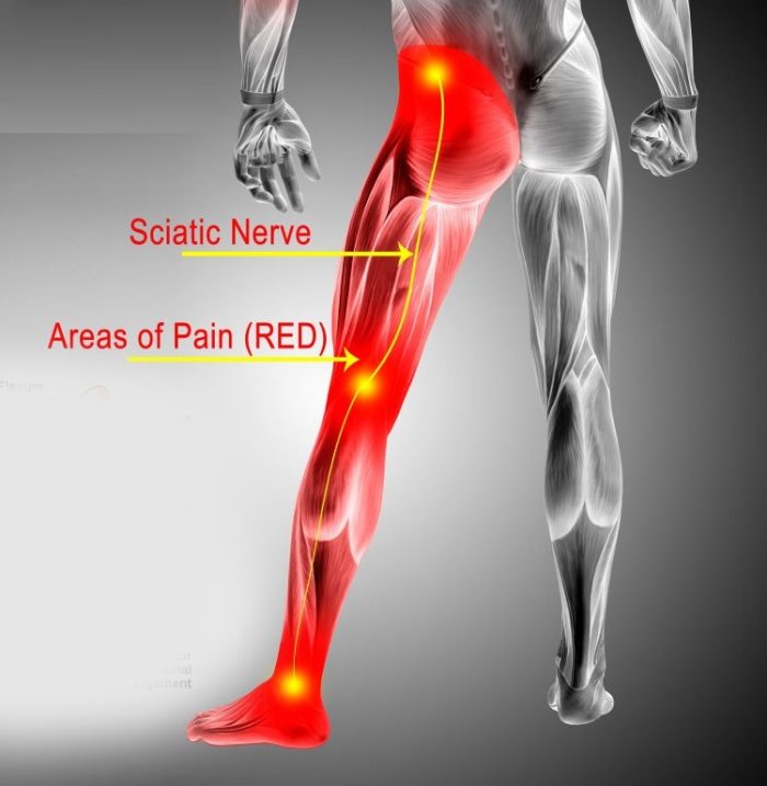 Sciatica: Understanding Back Pain - Northcote Chiropractor